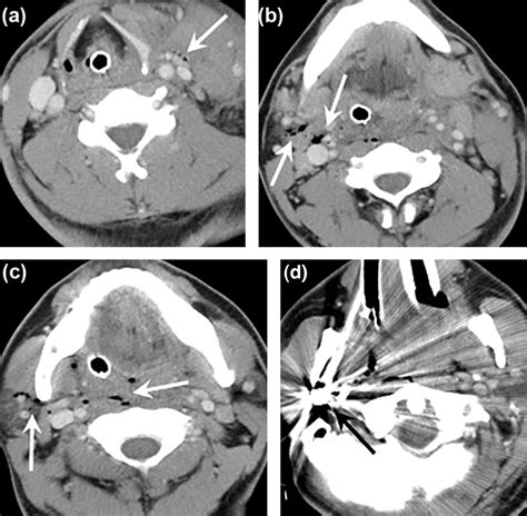 Ac Multislice Helical Computed Tomography Angiography MCTA Show
