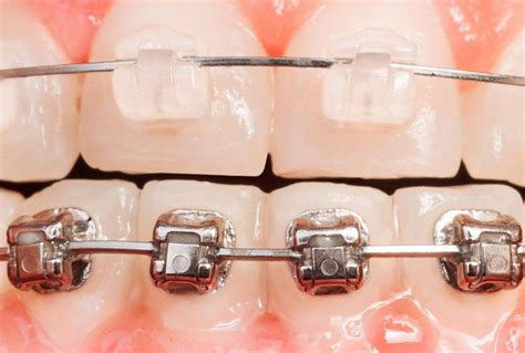 Braces Orthodontists In South Miami
