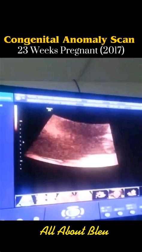 Congenital Anomaly Scan Pregnancy Tests Motherhood Funny