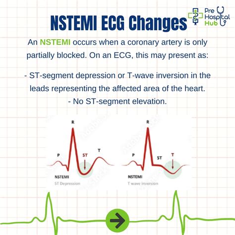 Pre Do You Know The Difference Between A Stemi And Nstemi Defibrillation Ecg Ekg