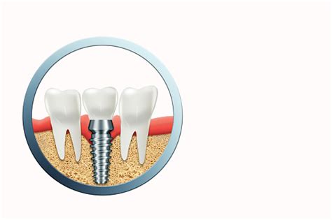 치과 용 임플란트 스테인리스 껌 포스트 의료 정보 포스터 치아 교체 개념 틀니 복사 공간 3d 일러스트레이션 3d 그래픽 3차원