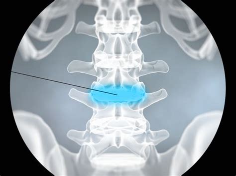 Video Intradiscal Injection Healthclips Online