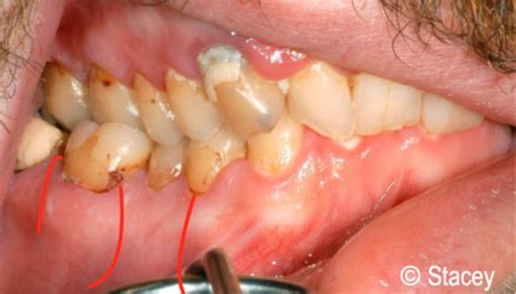 Recurrent Caries