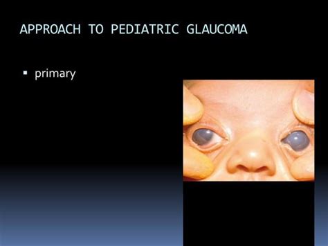 Approach To Pediatric Glaucoma Pptx Eye And Vision Conditions Diseases And Conditions