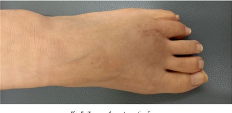 Figure 1 From The Onset Of Intermetatarsal Bursitis In Patient With