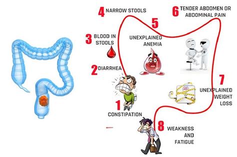 Rectal Cancer Diagnosis And Treatments From Top Cancer Hospital