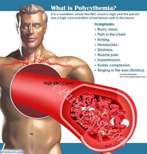 Polycythemiatypescausessymptomstreatmentcomplicationsrisk Factors
