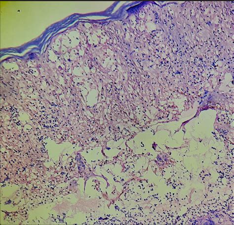 Degeneration” In Dermatopathology Indian Journal Of Dermatology