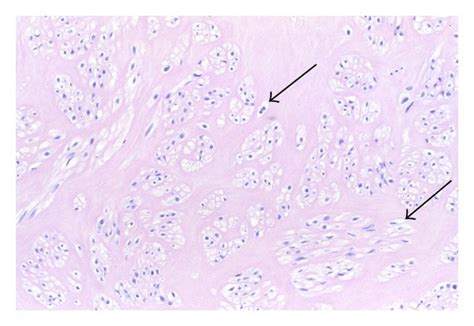 Vacuolization Of Myocytes In Phase 3 And 4 Fibroids Cytoplasmic Download Scientific Diagram