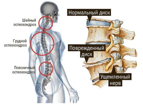 Остеохондроз грудного отдела позвоночника симптомы причины лечение