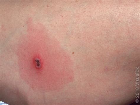 How To Identify A Spider Bite Pictures Of What To Look For Goodrx🕡 Explore As Vantagens E