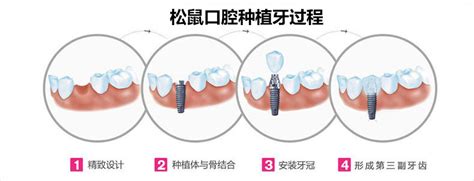 种牙好还是镶牙好