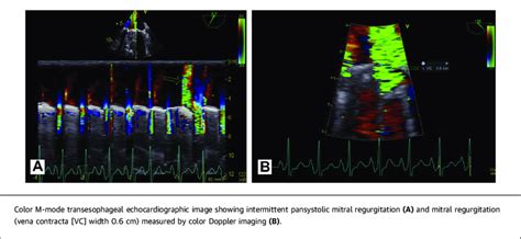 M Mode And Vena Contracta Views Of Severe Mitral Regurgitation Download Scientific Diagram