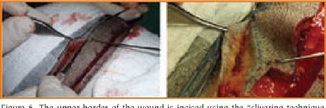 Figure 1 From Getting Maximum Follicular Units To Do A Megasession