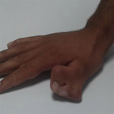 Relationship Between Wassel Classification And Functional Results Download Scientific Diagram