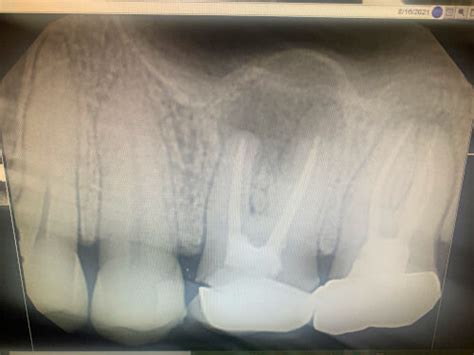 Sinus Exposure After Tooth Extraction 1311 Jackson Ave Dental