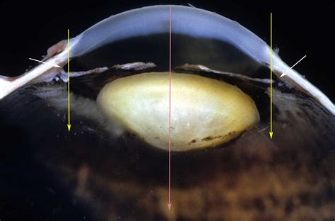 Angle Recession The Worried Well Glaucoma Today