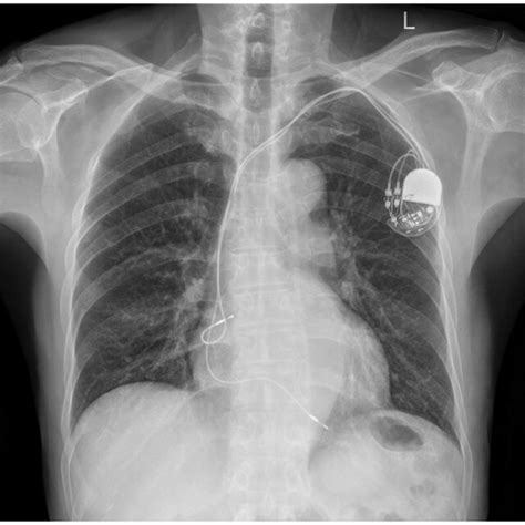 A Chest X Ray Shows The Position Of The Pacemaker And Electrode