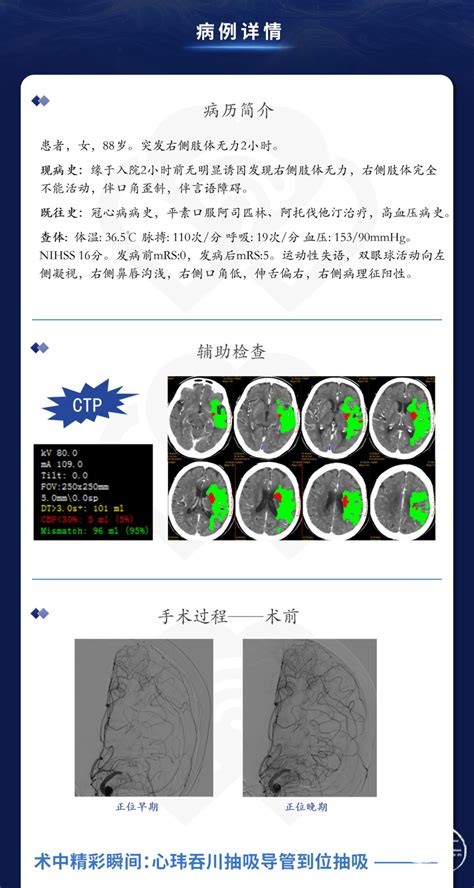 【全景手术】远大计划 易婷玉团队：心玮吞川颅内血栓抽吸导管应用于左侧大脑中动脉取栓一例 脑医汇
