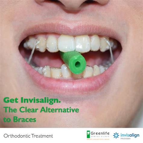 What Are Invisalign Chewies And What Do They Do Greenlife Dental