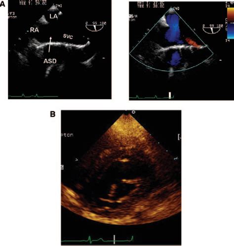 Structure Of Sinus Venosus Of Fetus Semantic Scholar