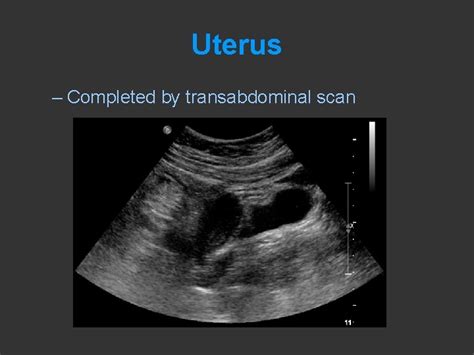 Ultrasonographic Anatomy Of The Pelvis Including Its 3