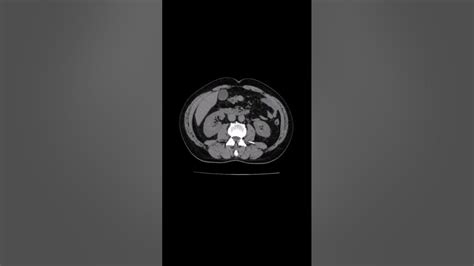 Appendicular Abscess On Abd Pelvis Ct Scan Ctscan Radiologyeducation Youtube