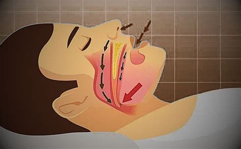 Treatments And Therapies Sleep Apnea