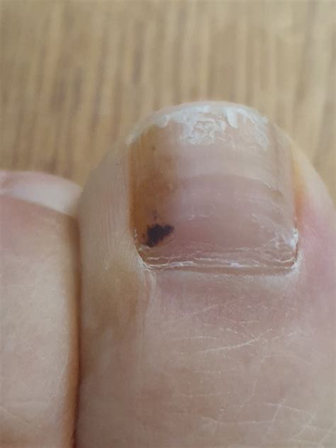 발톱에 검은점 지식in