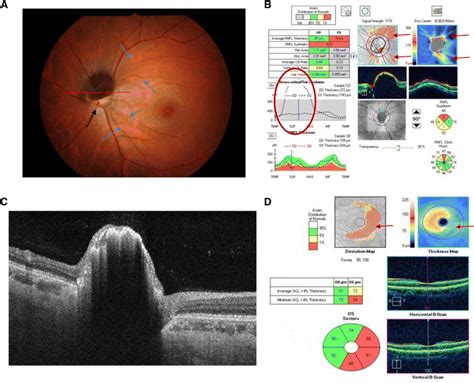 Fundus Photograph A Optical Coherence Tomography Findings Bd And Download Scientific
