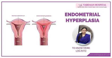 Endometrial Hyperplasia Endometrial Ablasion Endometrial Hyperplasia