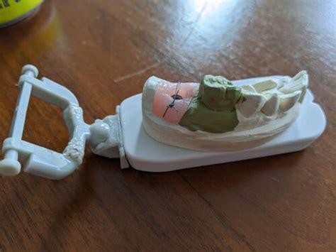 How To Know If Wisdom Teeth Stitches Came Out 1311 Jackson Ave Dental