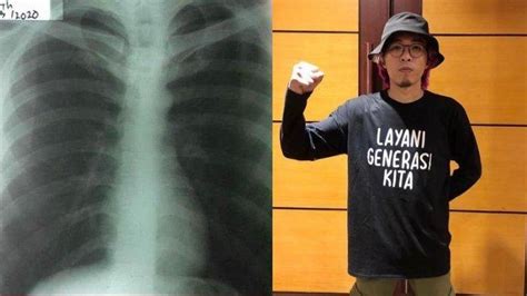 Foto Rontgen Paru Paru Dr Tirta Yang Tak Sehat Karena Merokok Kini Ia Menyesal And Ingin Tobat