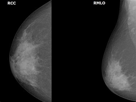 Atlas Of Breast Cancer Early Detection