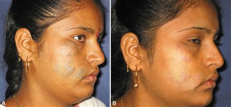 Venous Malformation Before And After Four Ndyag Download