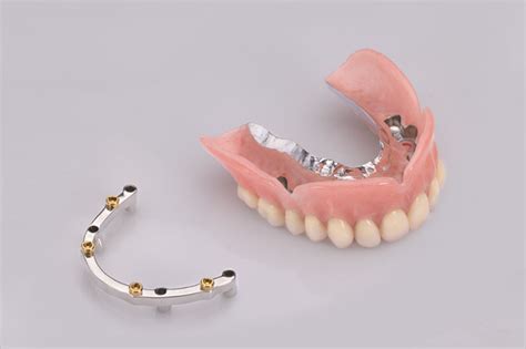 Implant Retained Overdentures Scd