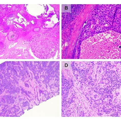 Timeline Of Patients Diagnoses And Secondary Malignancy Download