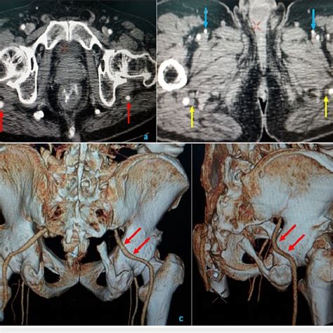 A Persistent Sciatic Artery In A 40 Year Old Male Patient Ct Angiogram Download Scientific