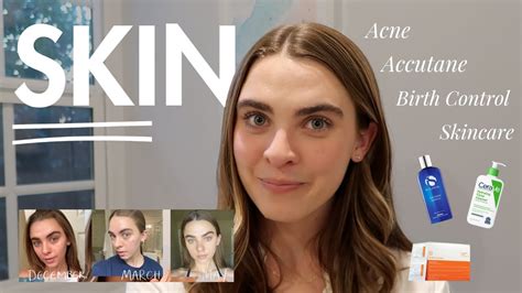 How I Cleared My Skin Hormonal Acne Accutane Cystic Acne And More