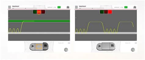 Respiratory Gating System