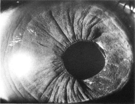 Sectoral Iris Atrophy From I To 6 Oclock In The Niasal Side Ofthe