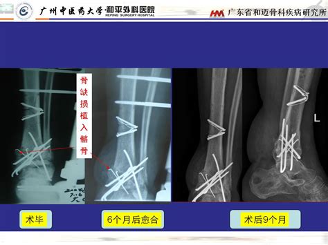显微技术治疗骨髓炎骨缺损