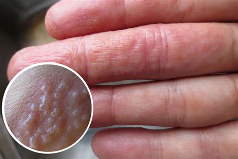 Nguyên Nhân Nào Gây Ra Hiện Tượng Nổi Mụn Nước ở Tay