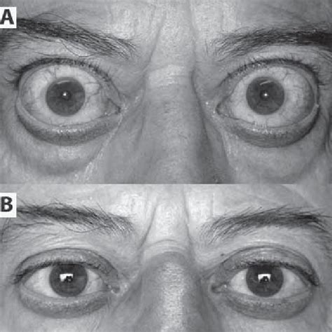A Marked Fat Proliferation In The Retrobulbar Space With Minimal Download Scientific Diagram