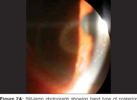 Figure 2 From In Vivo Confocal Microscopy In Different Types Of
