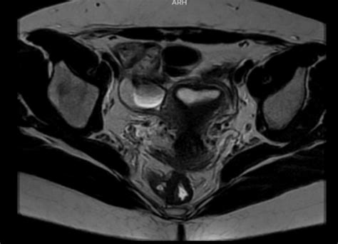 Parametrectomy And Discoid Resection For Deep Endometriosis Of The