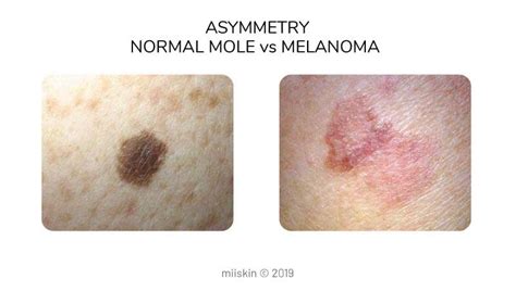 Melanoma Skin Moles