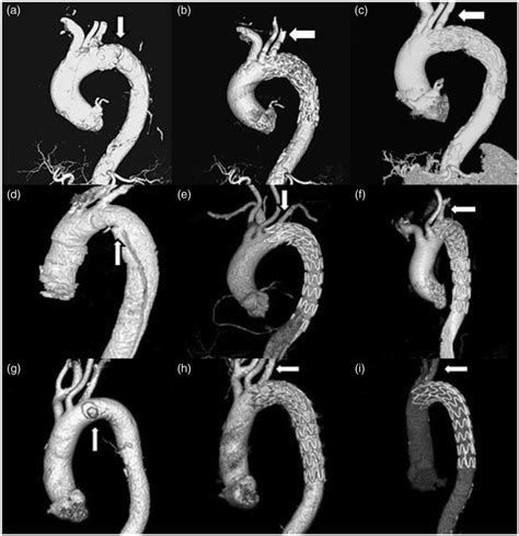 Computed Tomography Angiography Follow Up Results Of Different Aortic