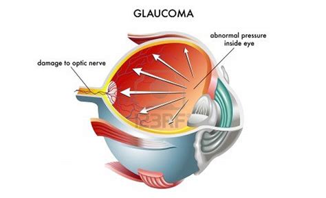 Signs And Symptoms For Glaucoma Hickey Optometry Optometrist In Fredericton