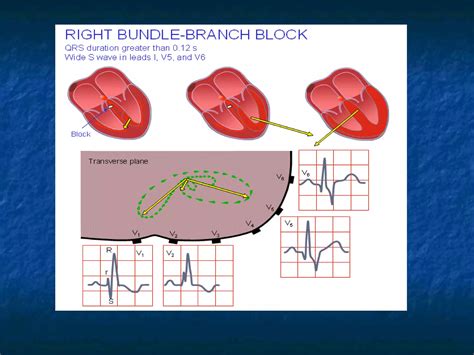 Right Bundle Branch Block Ppt